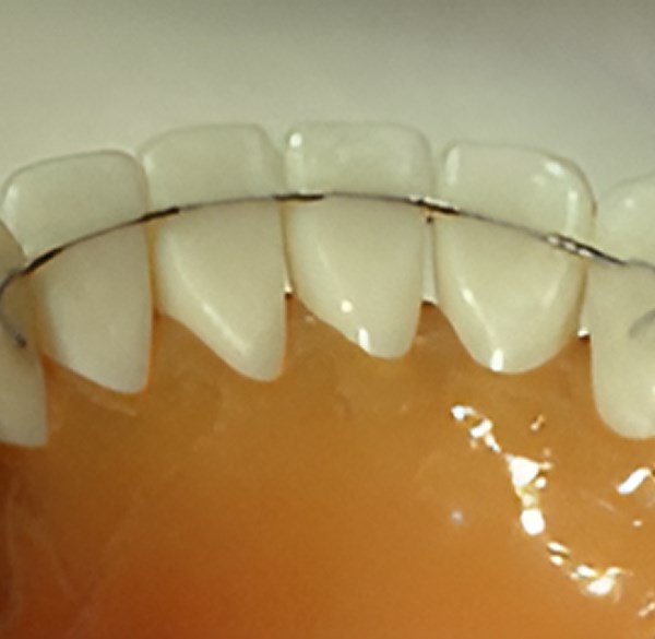 Retention | David Crowder, D.D.S. | Bartlett TN