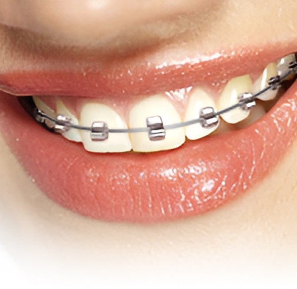 Types of Braces | David Crowder, D.D.S. | Bartlett TN